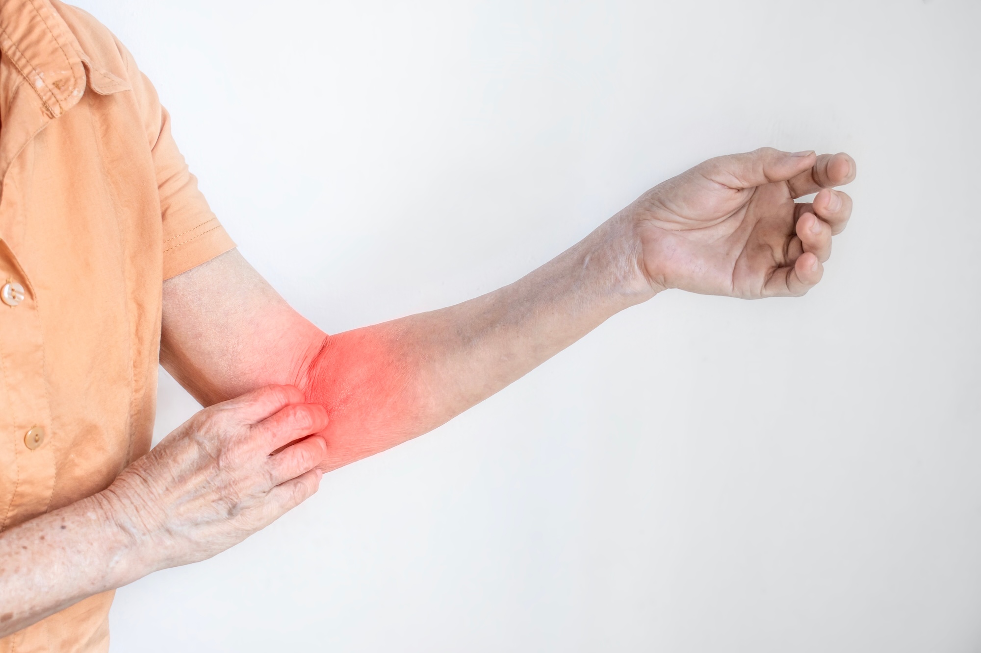 Psoriasis inversé (ou psoriasis des plus) : ce qu'il faut savoir ...