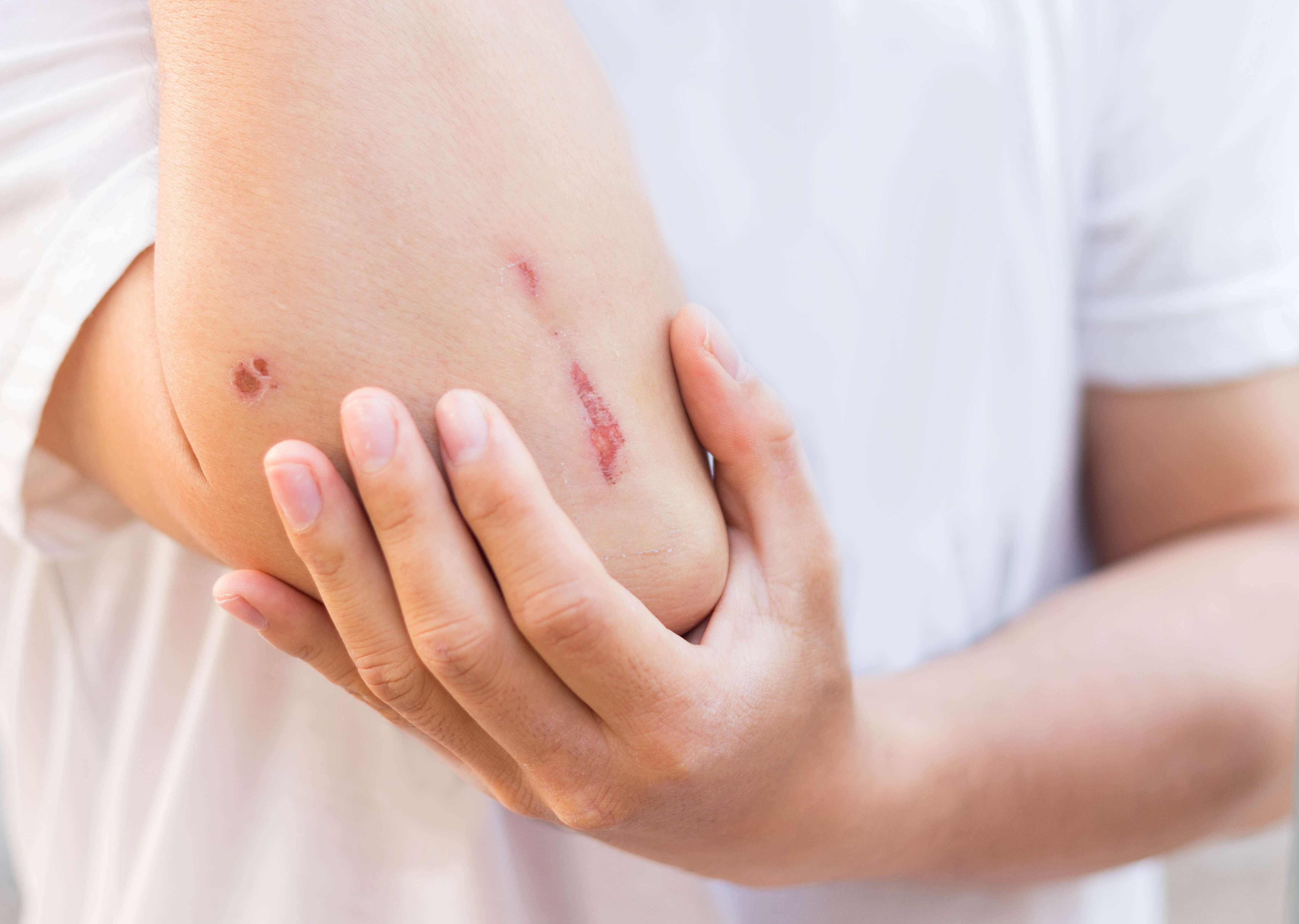 Plaie qui ne cicatrise pas : causes et soins efficaces - Aroma-Zone Plaie qui ne cicatrise pas : causes et soins efficaces - Aroma-Zone