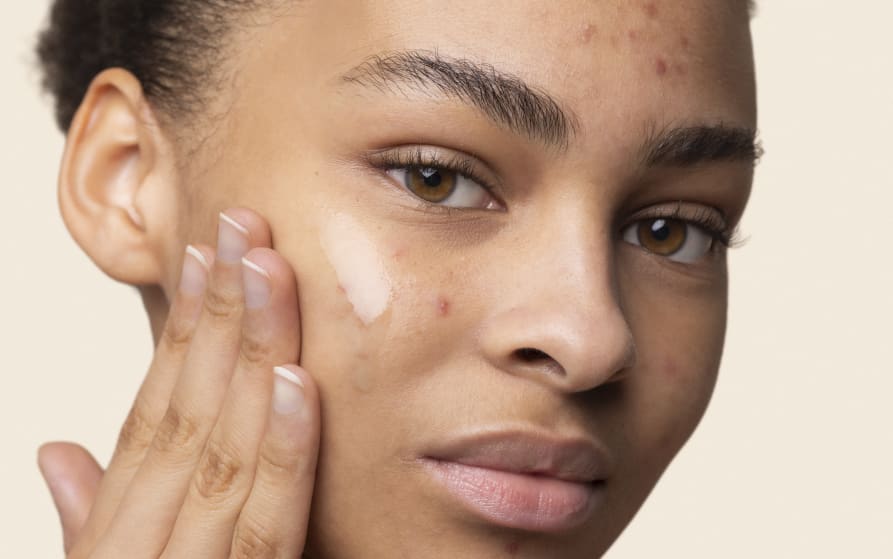 Boutons front : causes & solutions naturelles - Aroma-Zone