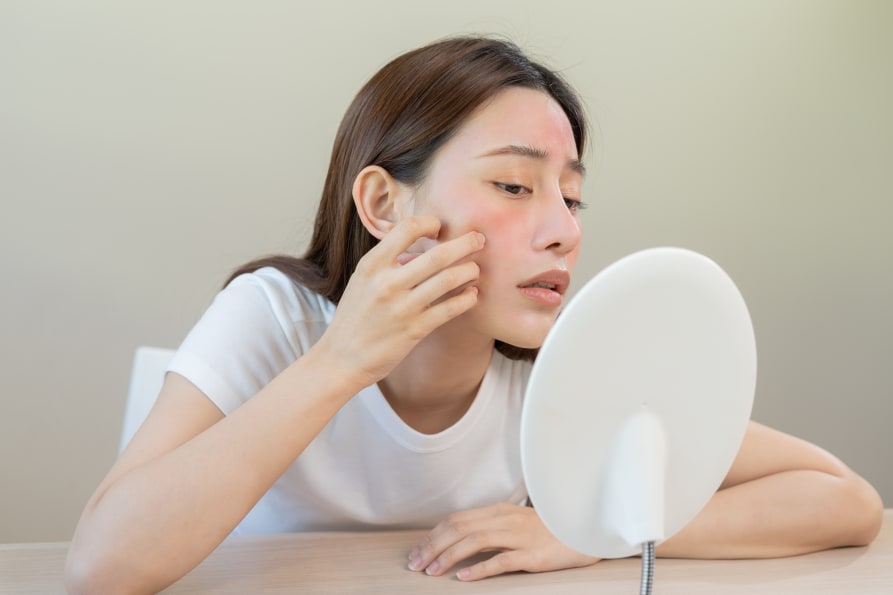 Urticaire allergique : causes, symptômes, solutions naturelles... tout ...